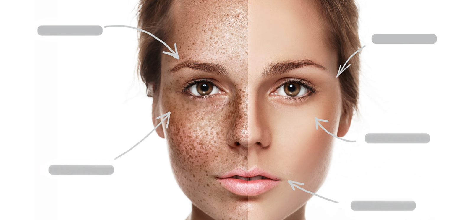 Melasma and Freckles Reduction – Aesthetica